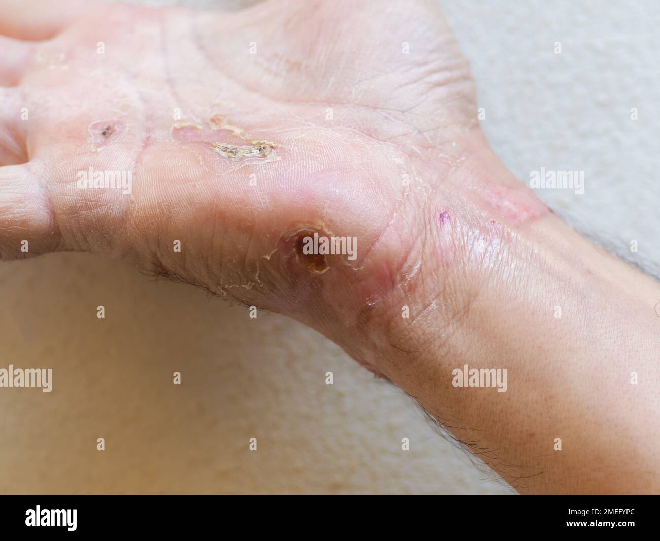 Electrical Burns Entry Exit