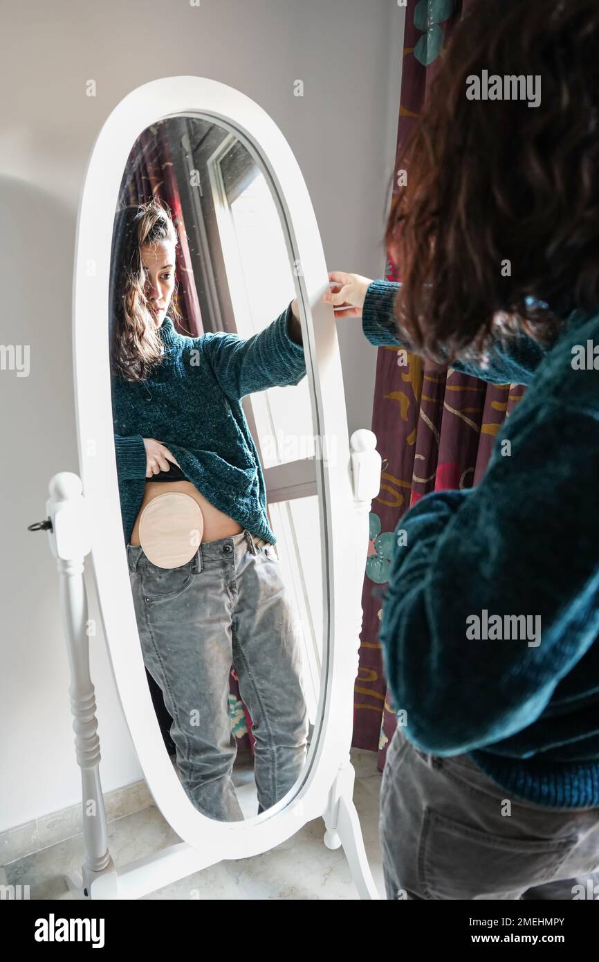 young woman with an ostomy bag on her belly looks in the mirror at home. Self-esteem and ...