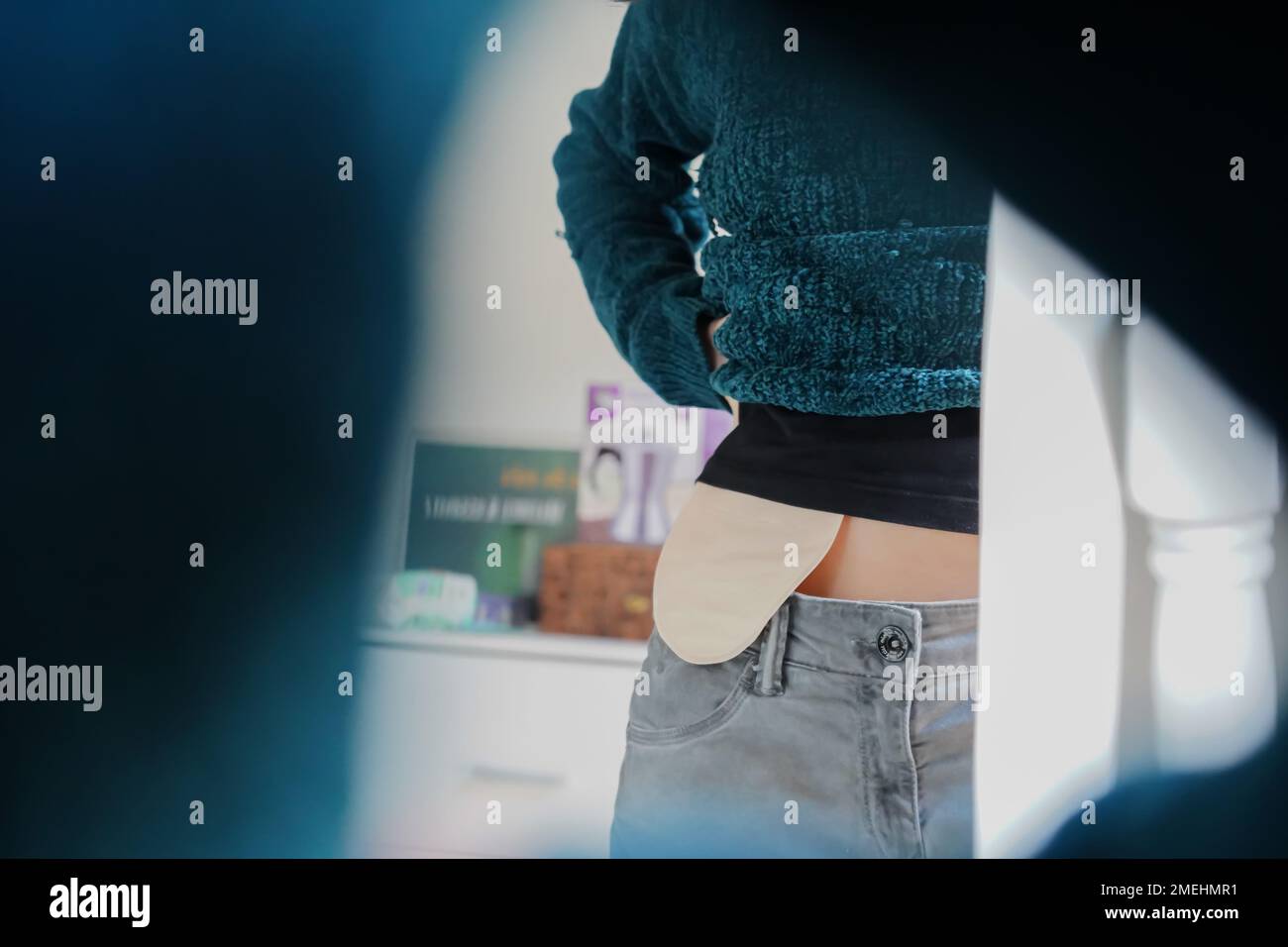 A female colon cancer survivor looking at the ostomy bag in the mirror ...