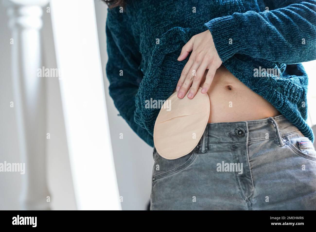Woman with ostomy bag hi-res stock photography and images - Alamy