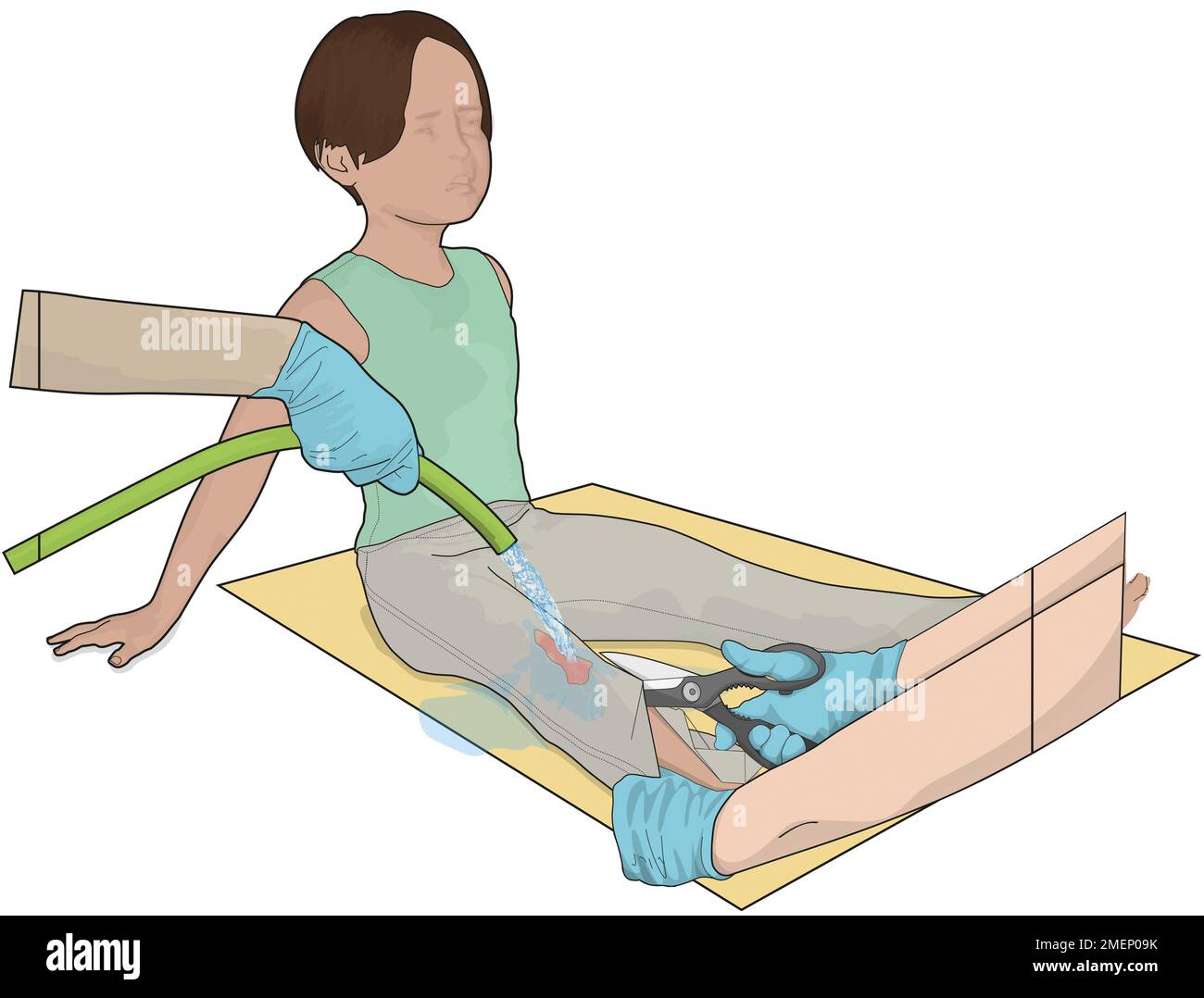 Burns and scalds hi-res stock photography and images - Alamy