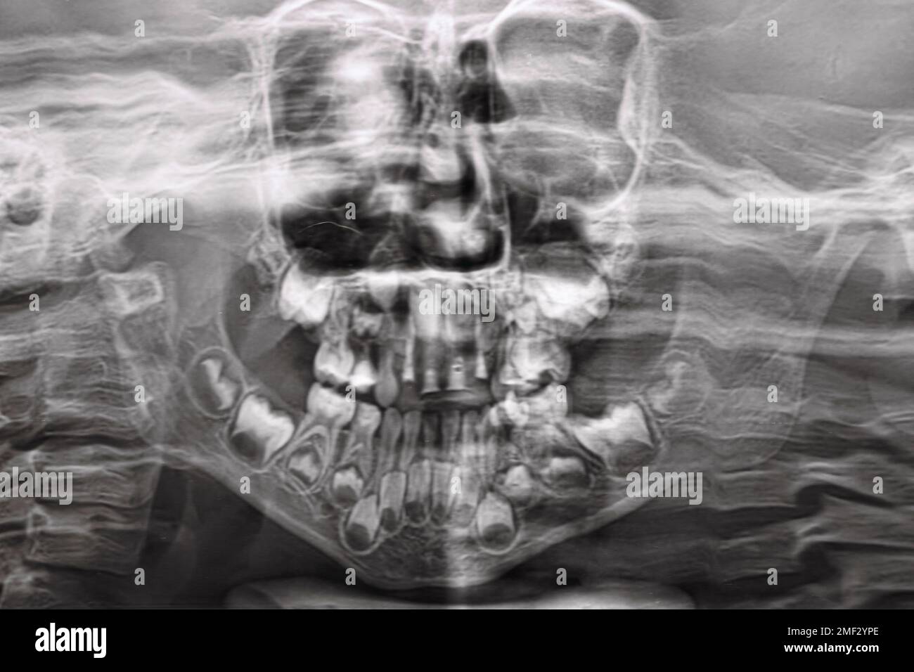 A panoramic X-ray shows several embedded and impacted teeth on both the ...