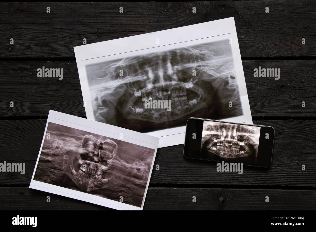 Panoramic shot shows several embedded and impacted teeth on both the ...