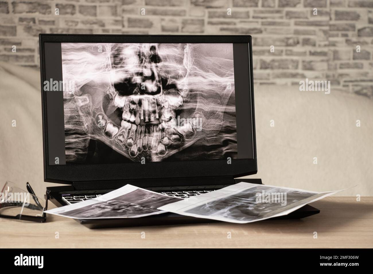 panoramic X-ray of children's teeth of two jaws, orthopantomogram of ...