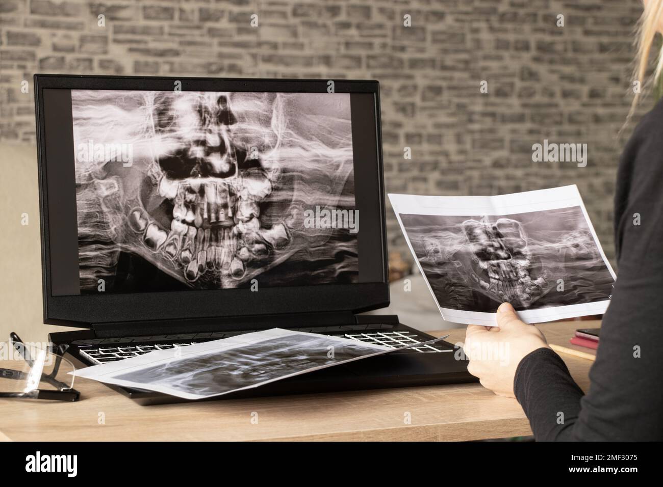 panoramic X-ray of children's teeth of two jaws, orthopantomogram of ...