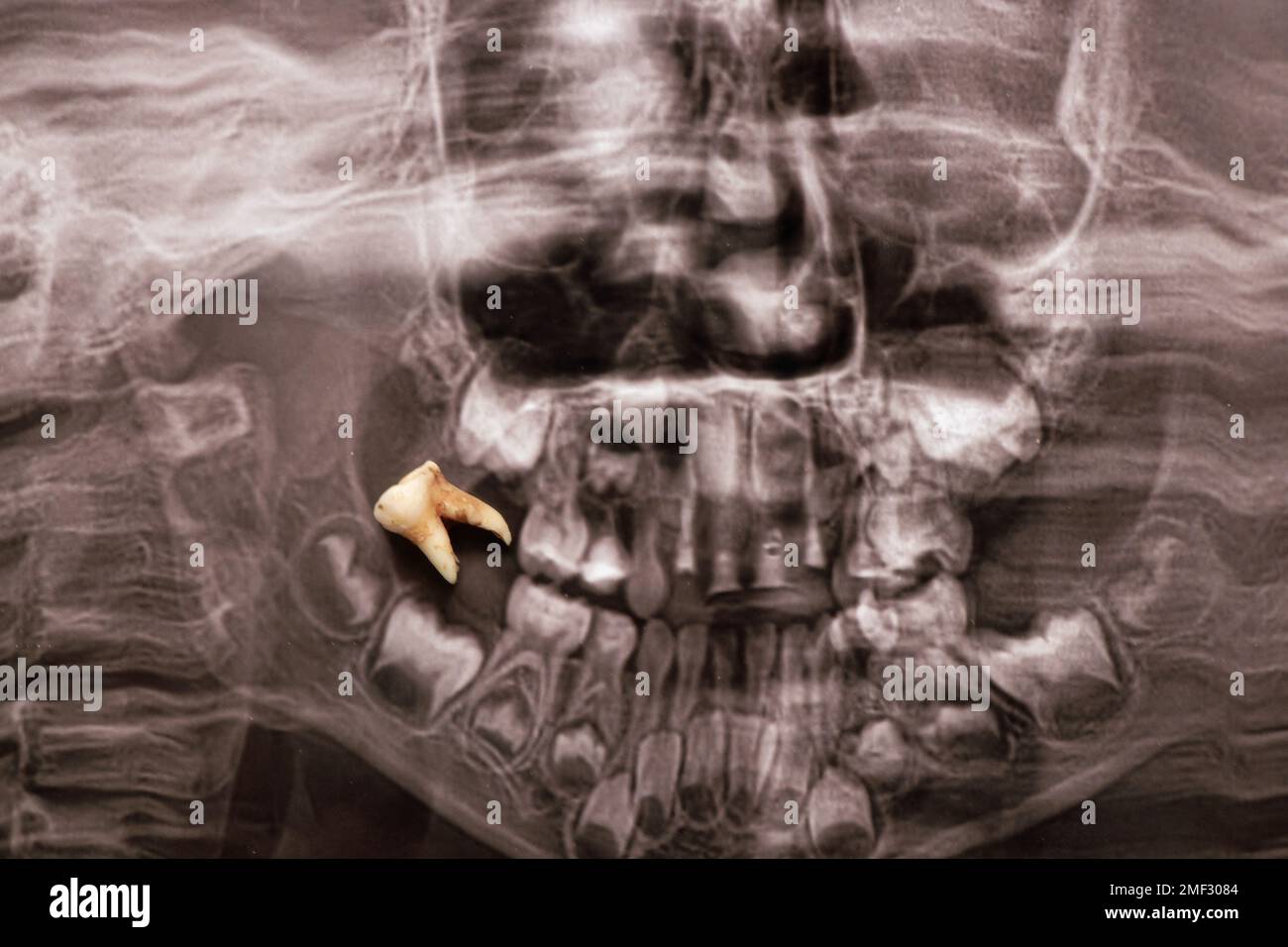 The panoramic image shows several embedded and impacted teeth as on the ...