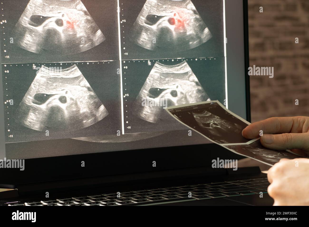 Ultrasound of a woman's abdomen on a laptop screen monitor in a doctor ...