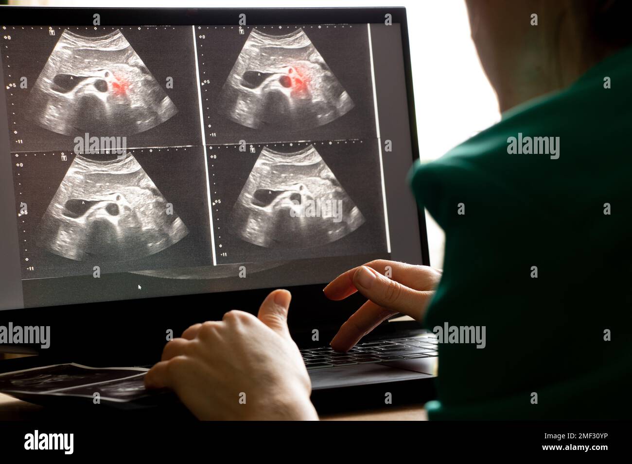 Ultrasound of a woman's abdomen on a laptop screen monitor in a doctor ...