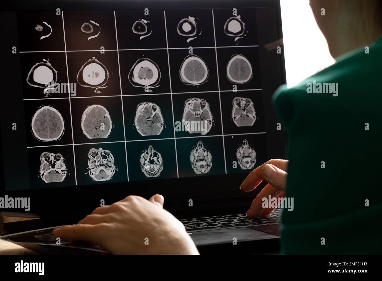 3D computed tomography of the brain with a fracture of the frontal part ...