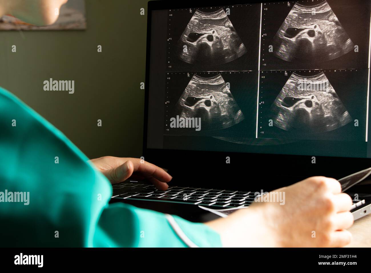 Ultrasound of a woman's abdomen on a laptop screen monitor in a doctor ...
