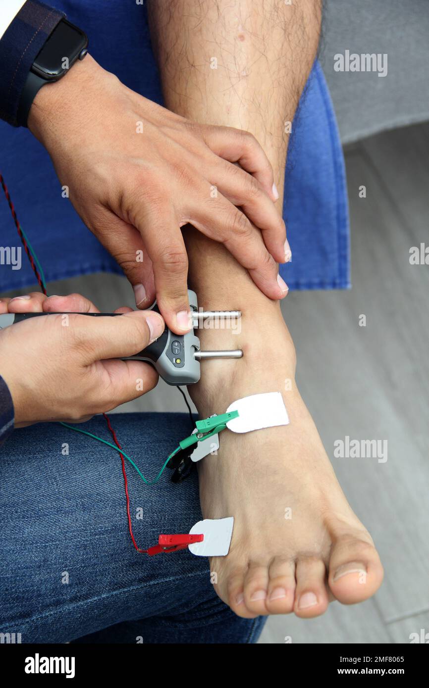 Somatosensory Evoked Potentials (SEP) or Nerve Conduction Velocity (NCV ...