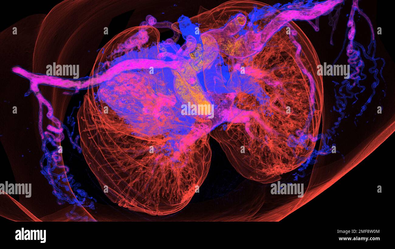 Collateral circulation in aortic coarctation, CT scan Stock Photo - Alamy