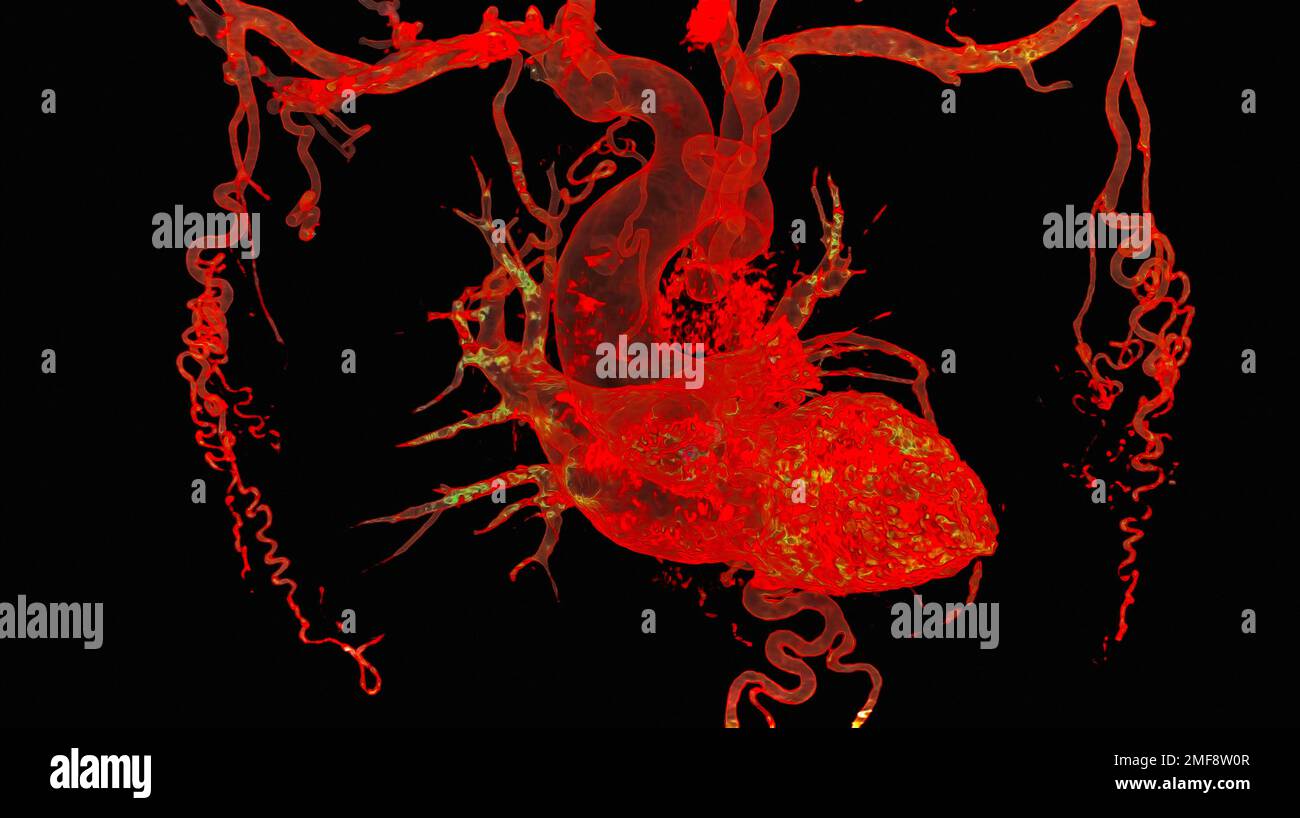 Collateral circulation in aortic coarctation, CT scan Stock Photo - Alamy