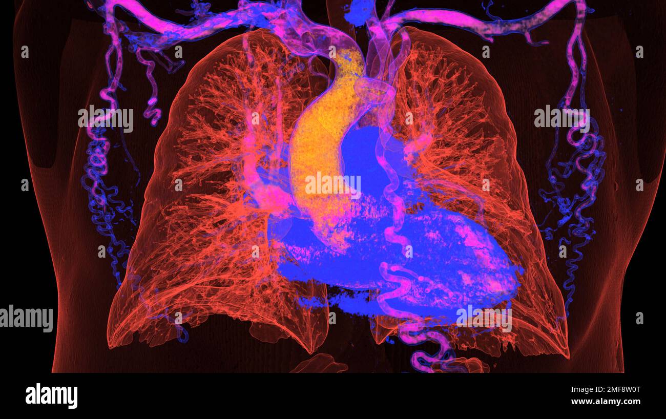 Collateral circulation in aortic coarctation, CT scan Stock Photo - Alamy