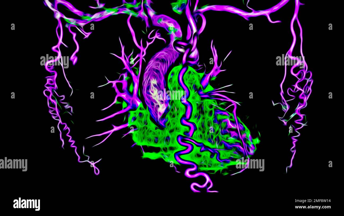 Collateral circulation in aortic coarctation, CT scan Stock Photo - Alamy
