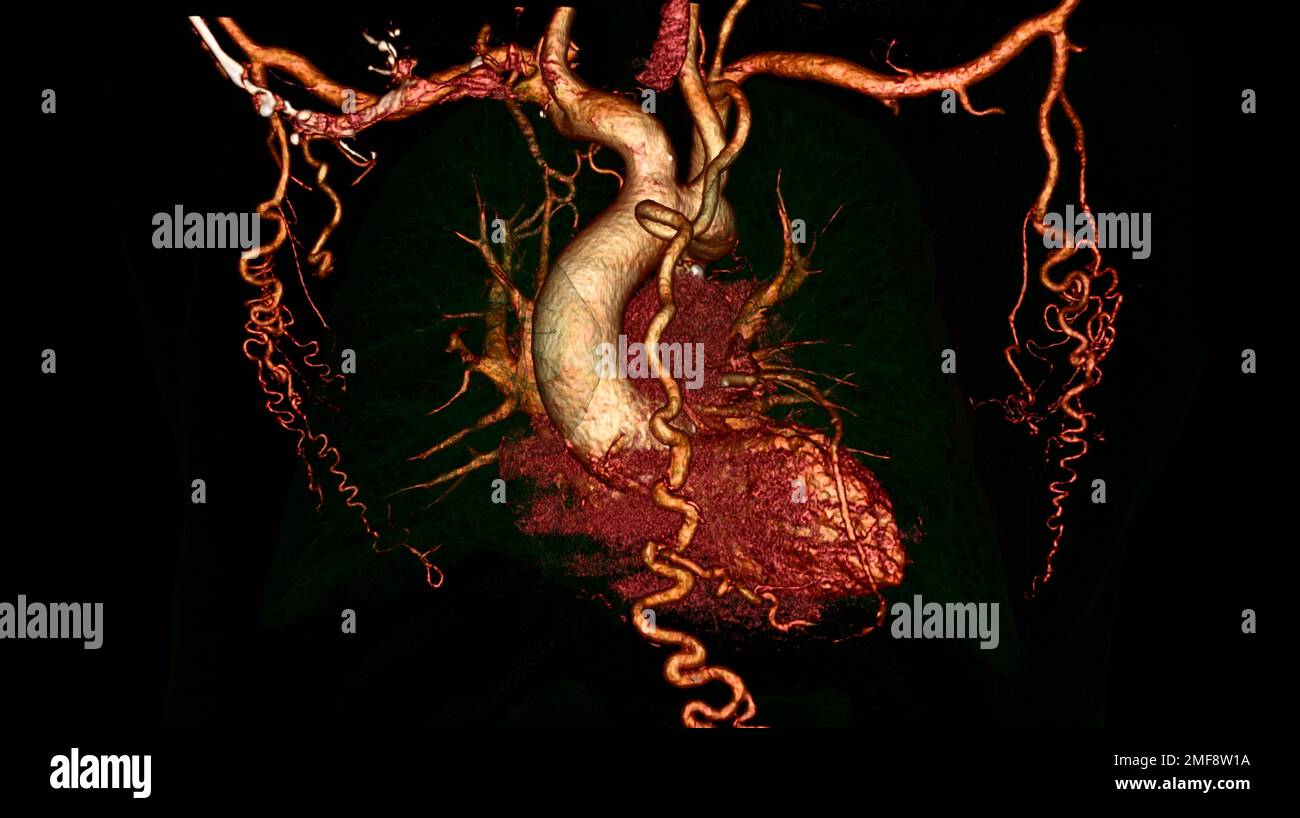 Collateral circulation in aortic coarctation, CT scan Stock Photo - Alamy