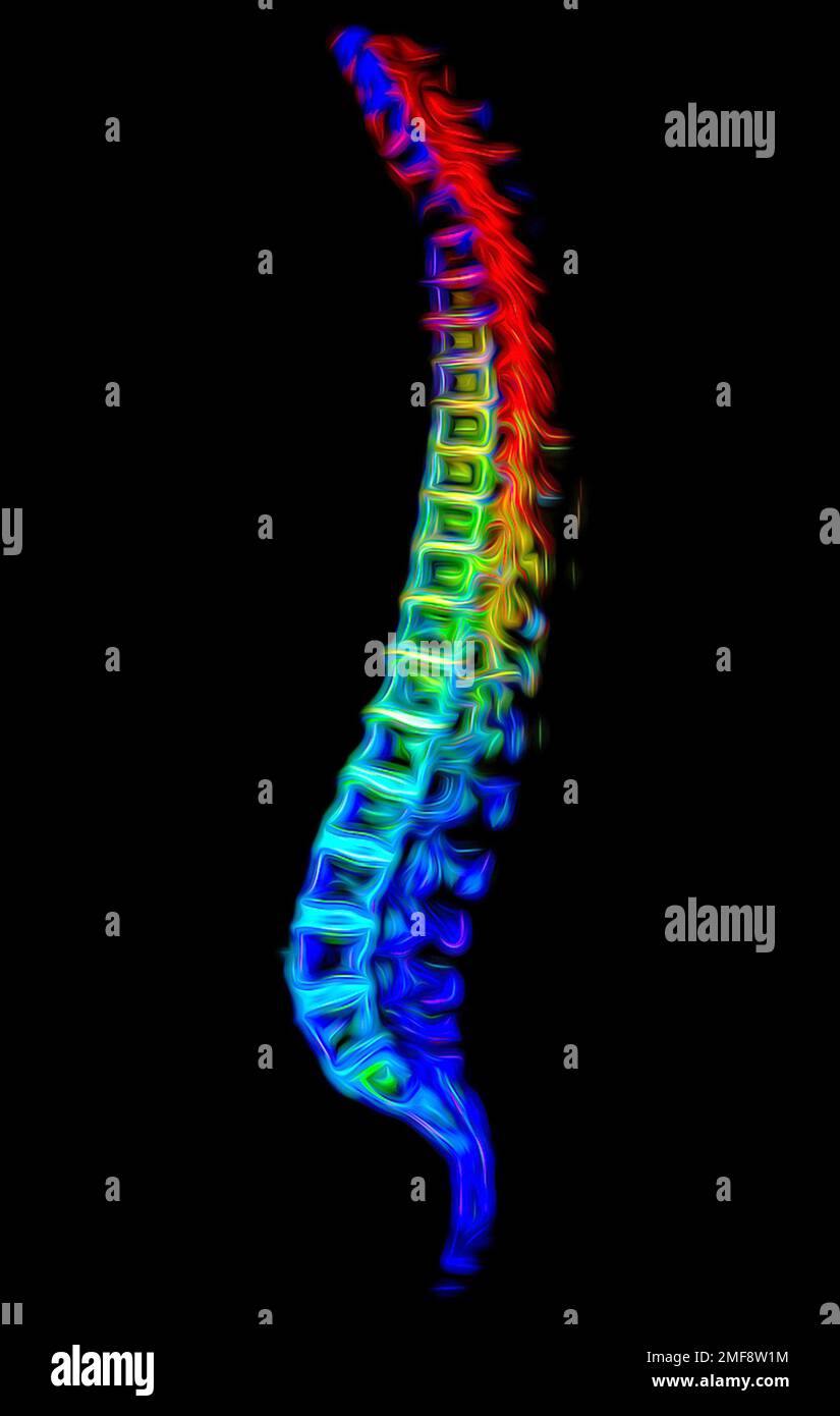Spine, CT scan Stock Photo - Alamy