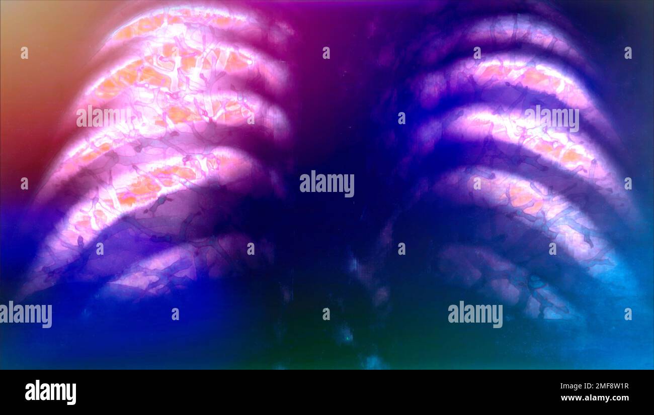 Ribs, CT scan Stock Photo - Alamy