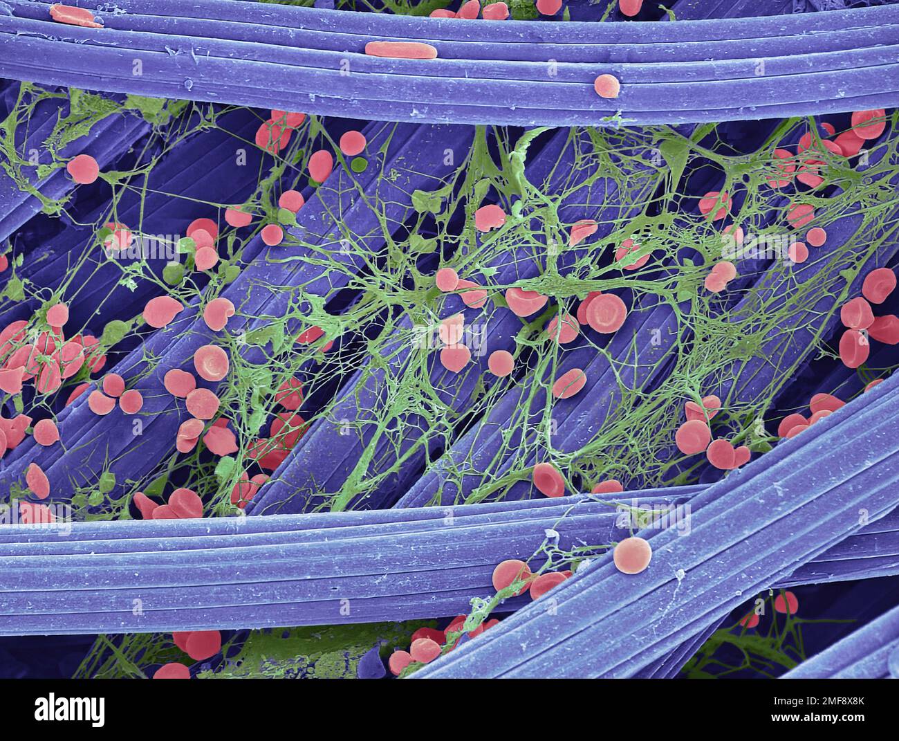 Blood clot on plaster, SEM Stock Photo - Alamy