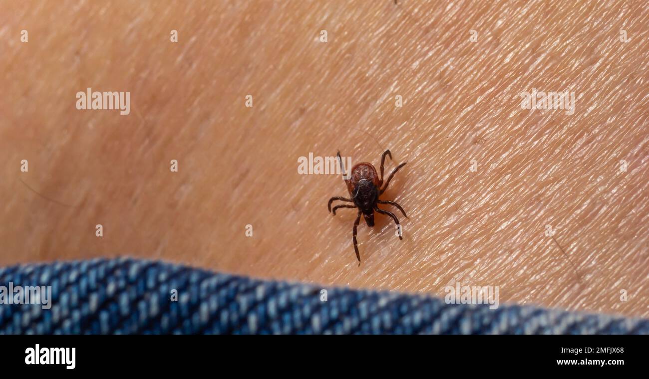 The parasite mite sits on a persons skin. infection carrier. Ixodes ...