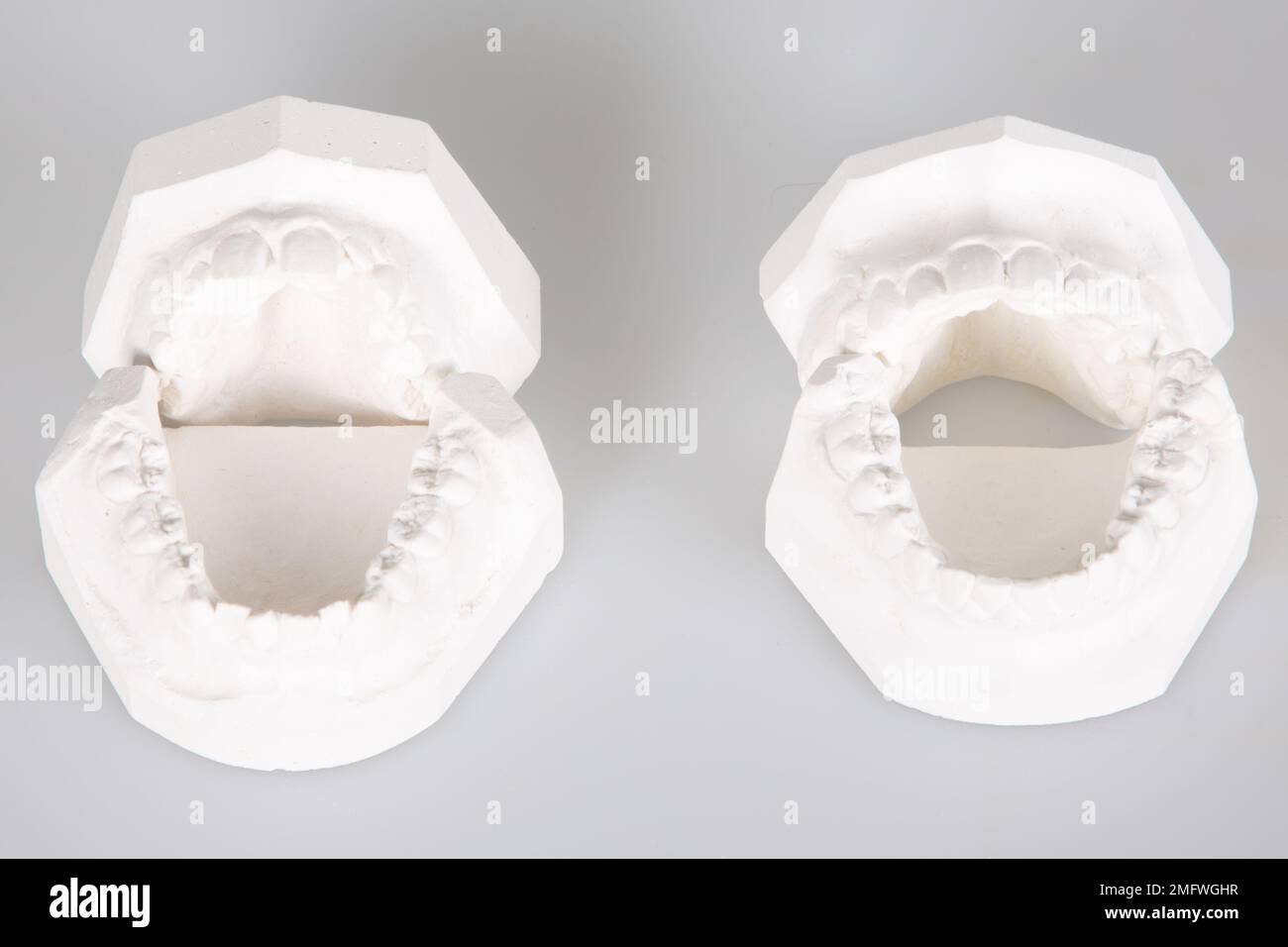 Dental bridge before after hi-res stock photography and images - Alamy