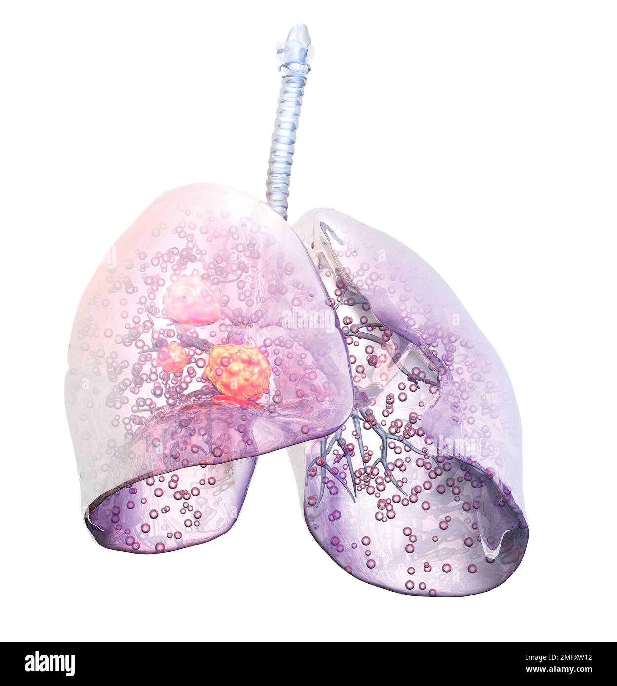 3D Illustration showing lung cancer Stock Photo - Alamy