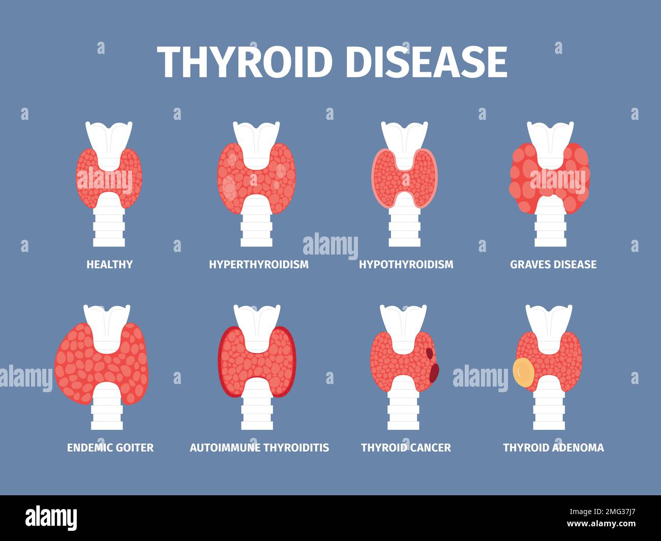 Thyroid gland various diseases. Goiter and hyperthyroid, inflammation ...