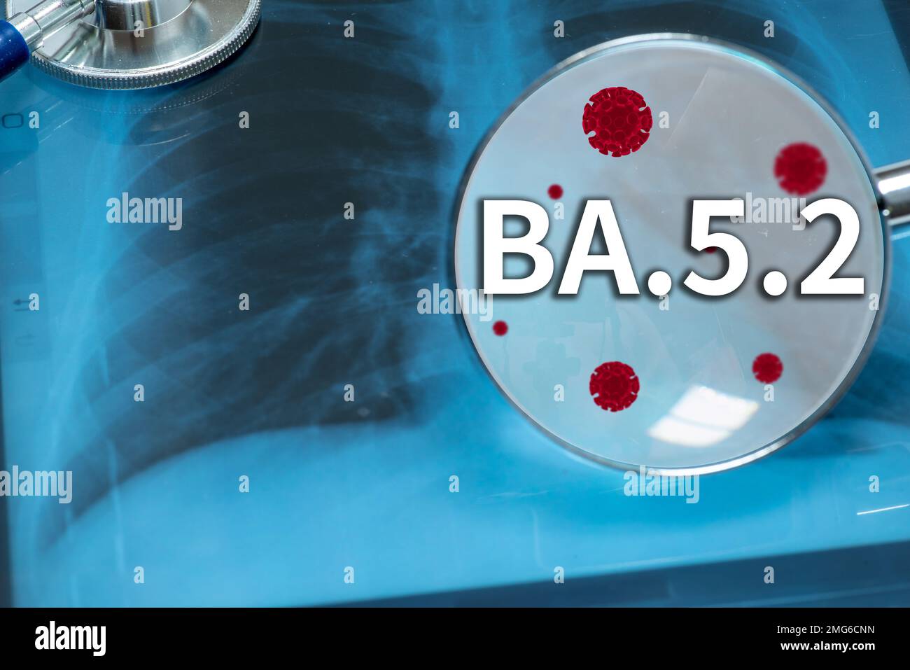 X ray tuberculosis hi-res stock photography and images - Alamy