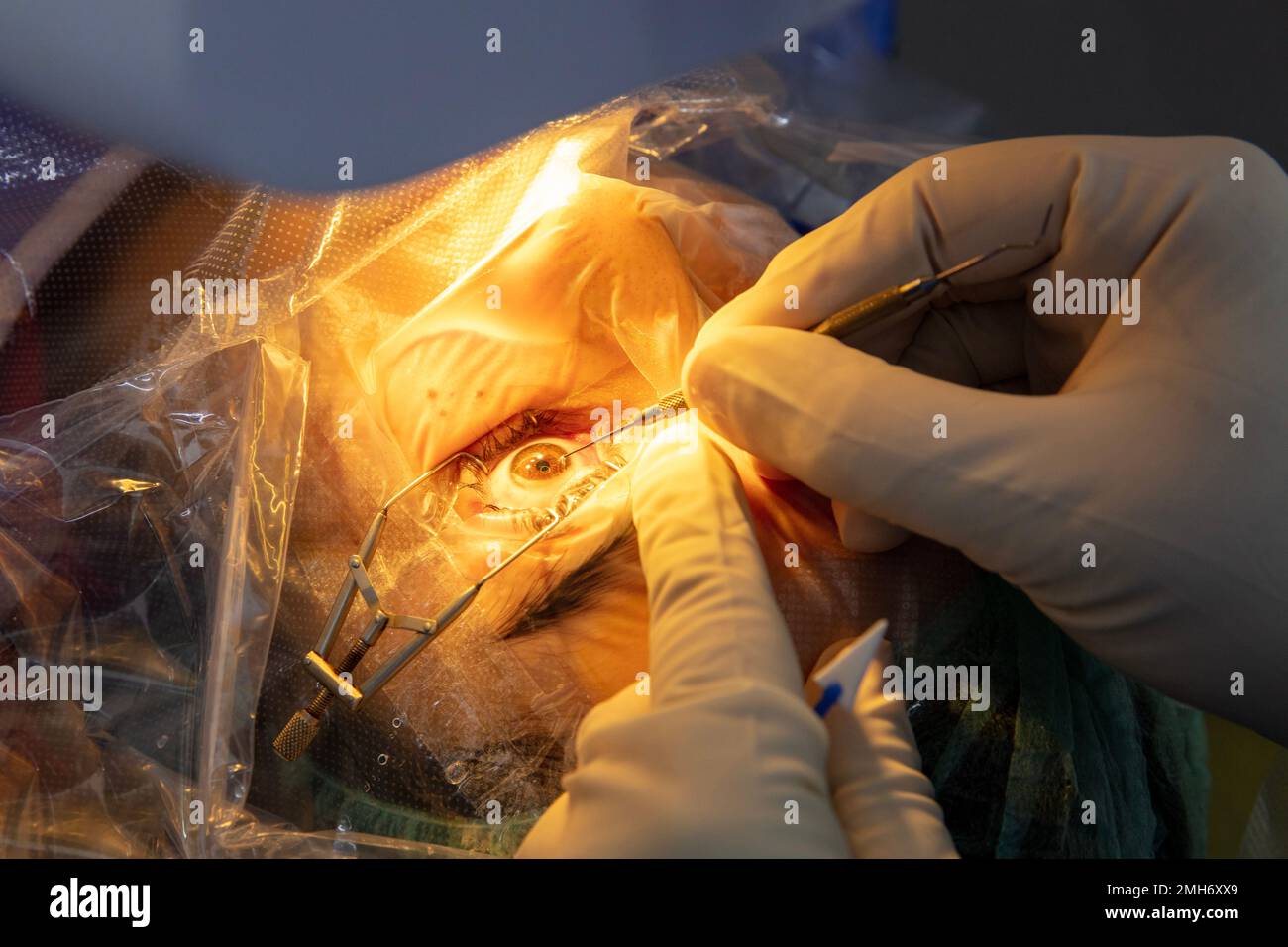 Macula operation hi-res stock photography and images - Alamy