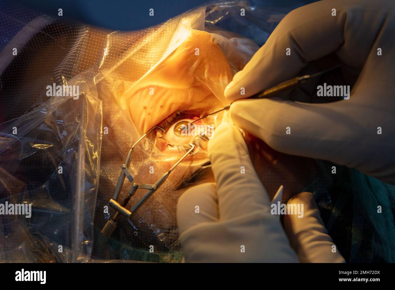 Eye surgery process, treatment of cataract and diopter correction ...