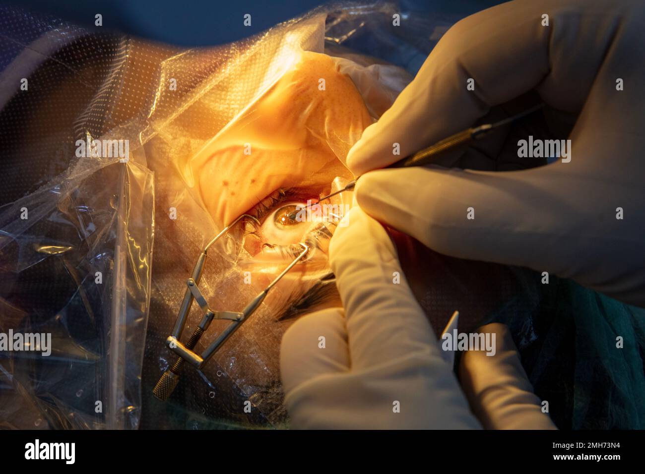 Eye surgery process, treatment of cataract and diopter correction ...