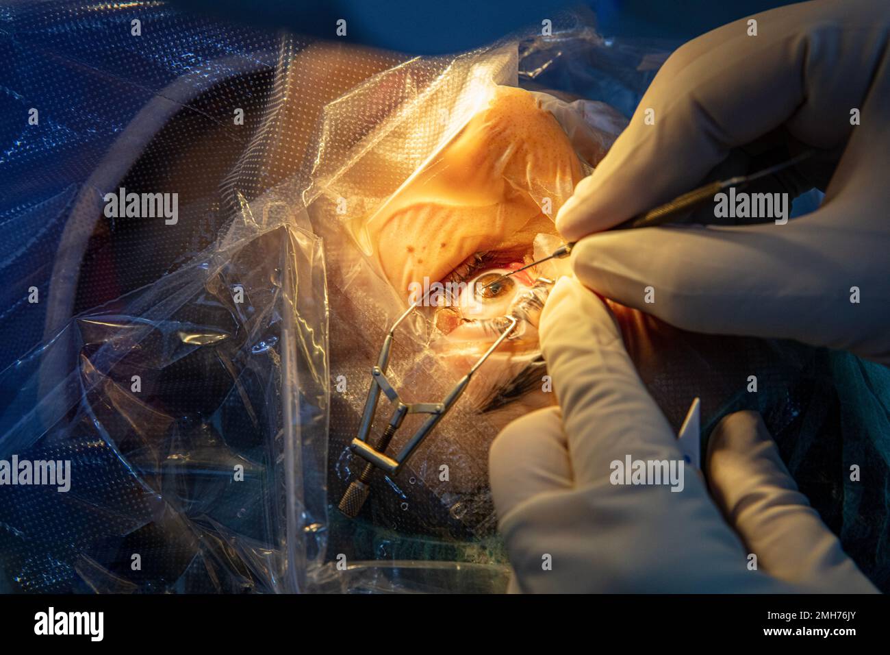 Eye surgery process, treatment of cataract and diopter correction ...