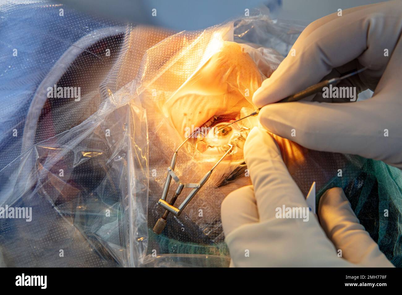 Eye surgery process, treatment of cataract and diopter correction ...