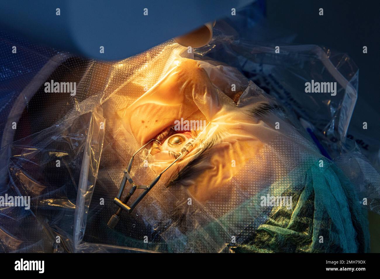 Diopter Lens Implant at Ruby Najar blog