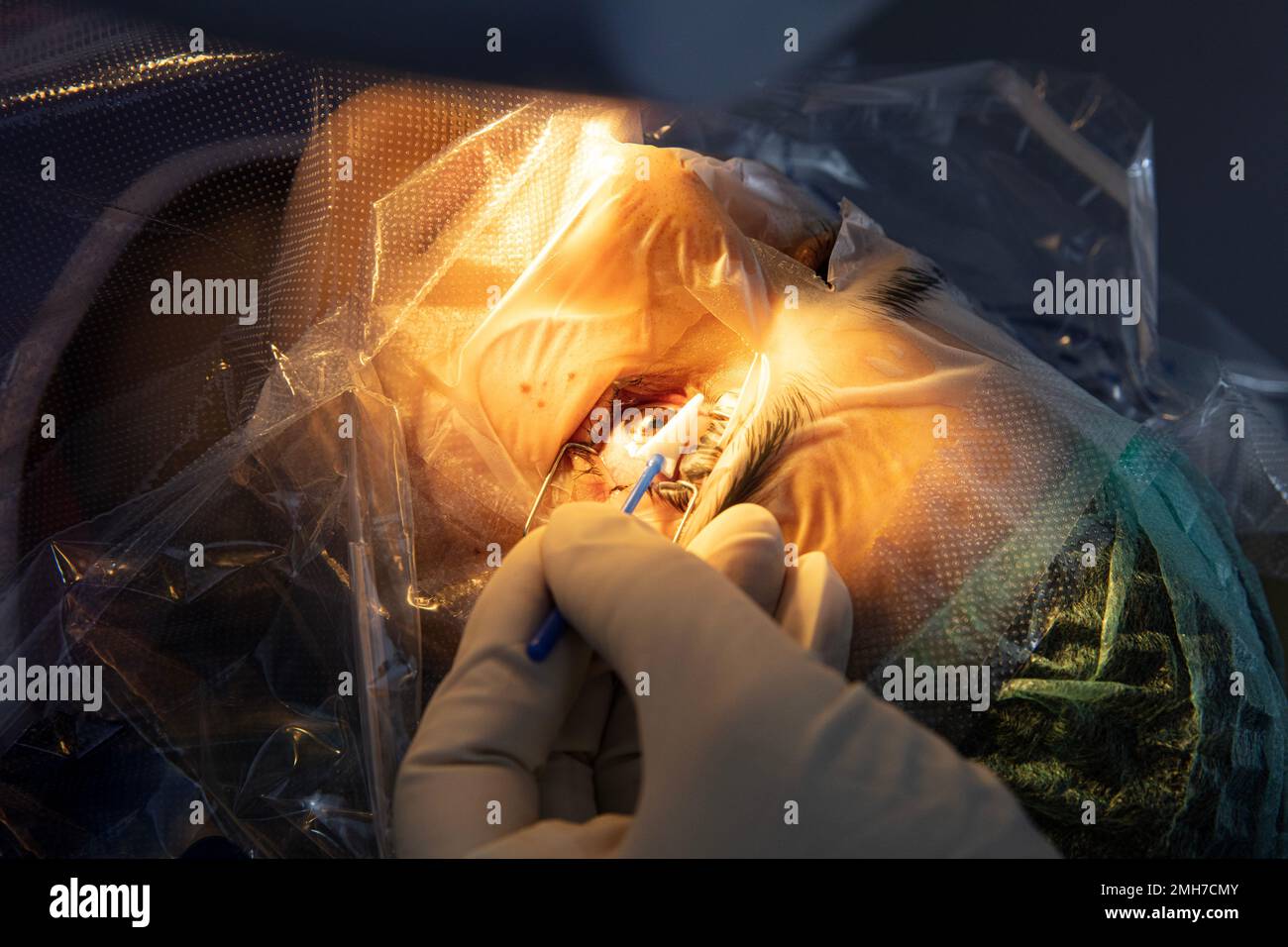 Eye surgery process, treatment of cataract and diopter correction ...
