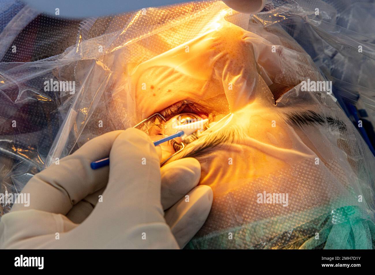 Eye surgery process, treatment of cataract and diopter correction ...