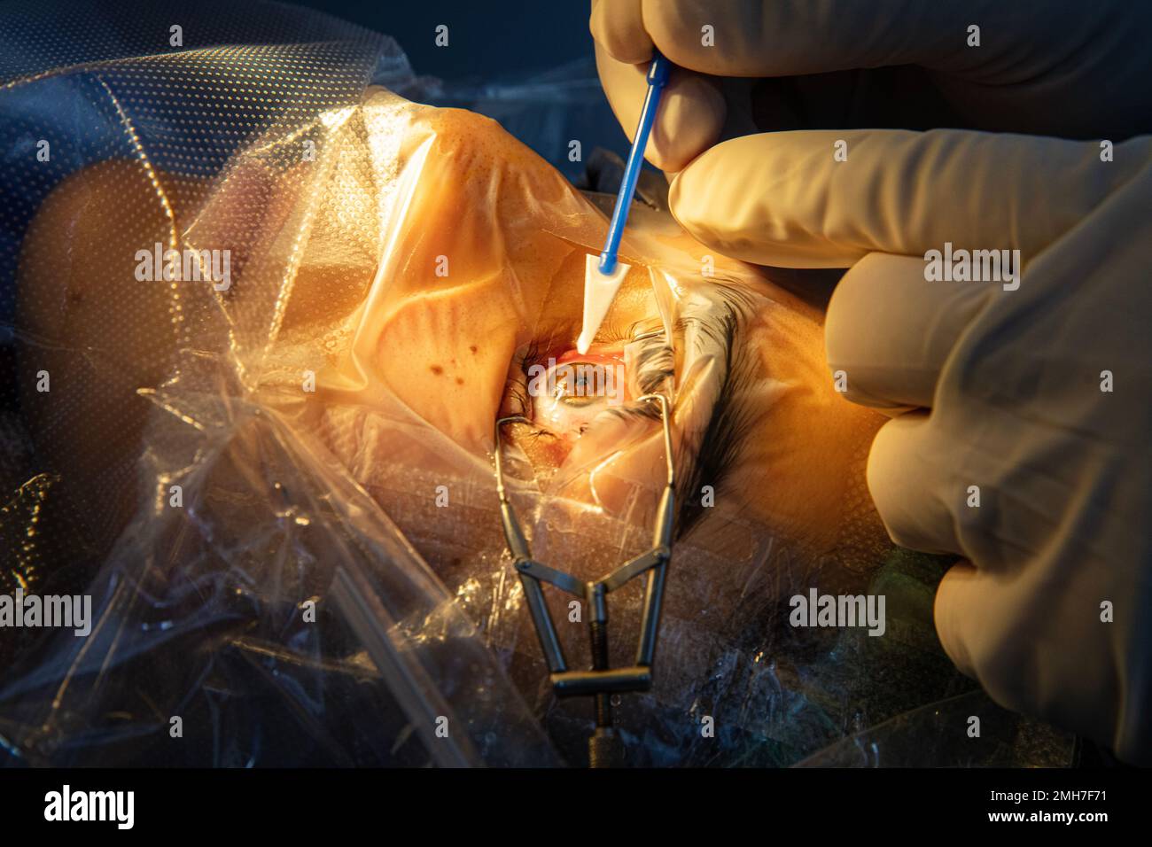 Eye surgery process, treatment of cataract and diopter correction ...