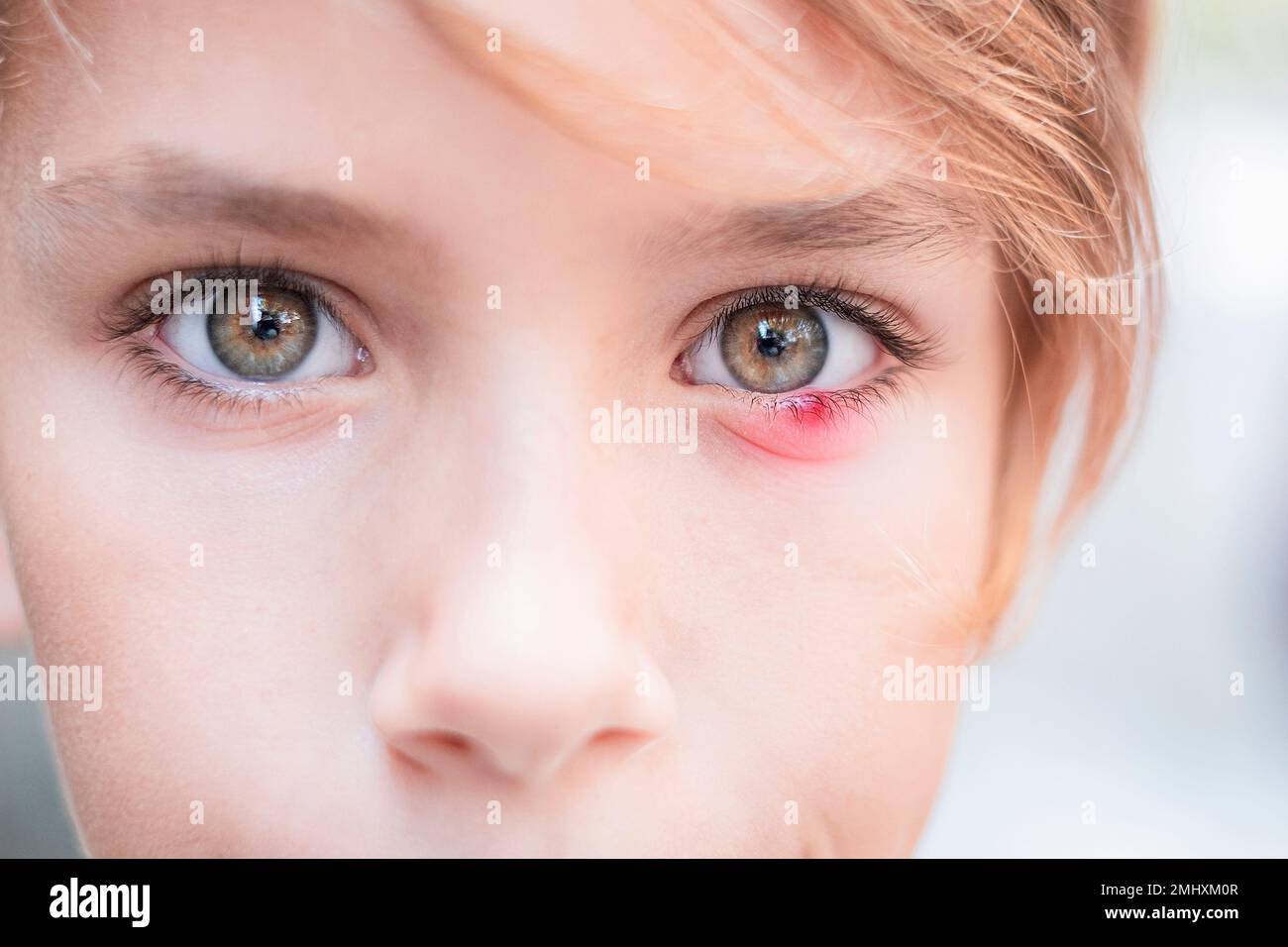 Eye Stye Treatment Child at Loren Bona blog