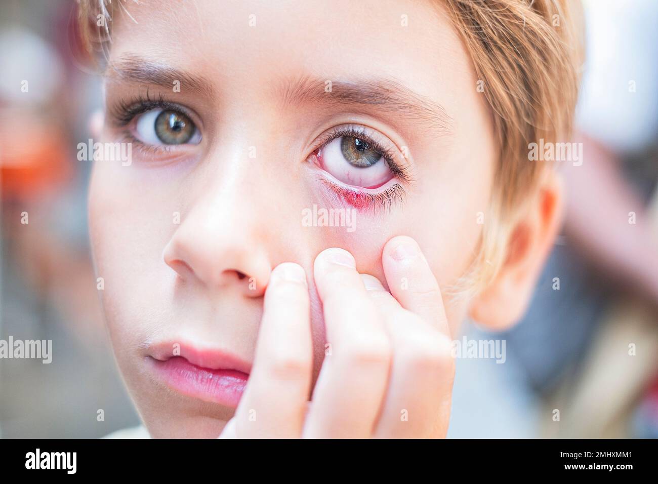 Close up of a child eye stye. Ophthalmic hordeolum disease Stock Photo ...