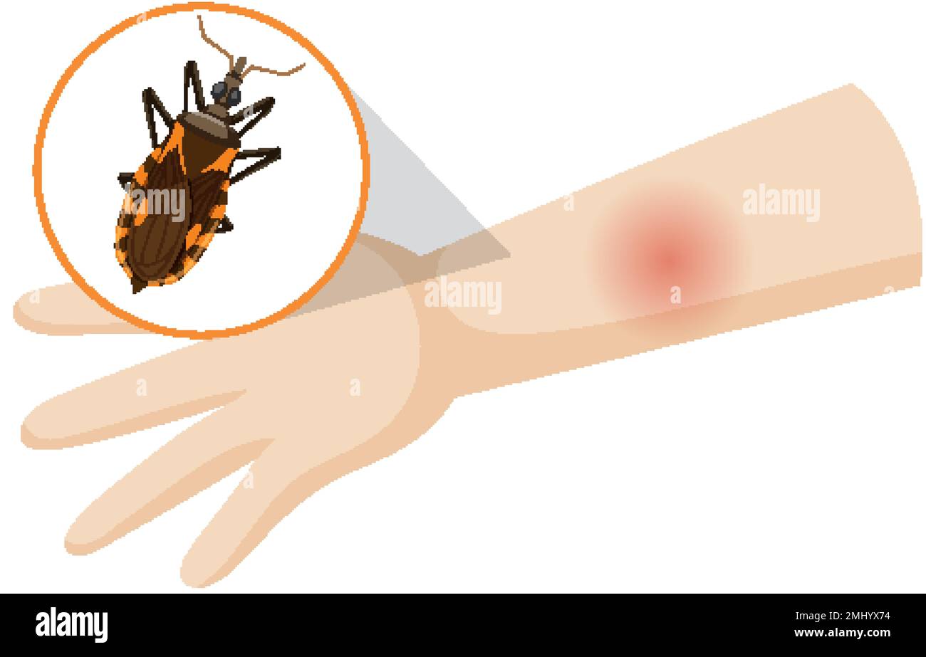 Human arm swollen from kissing bug bite illustration Stock Vector Image ...