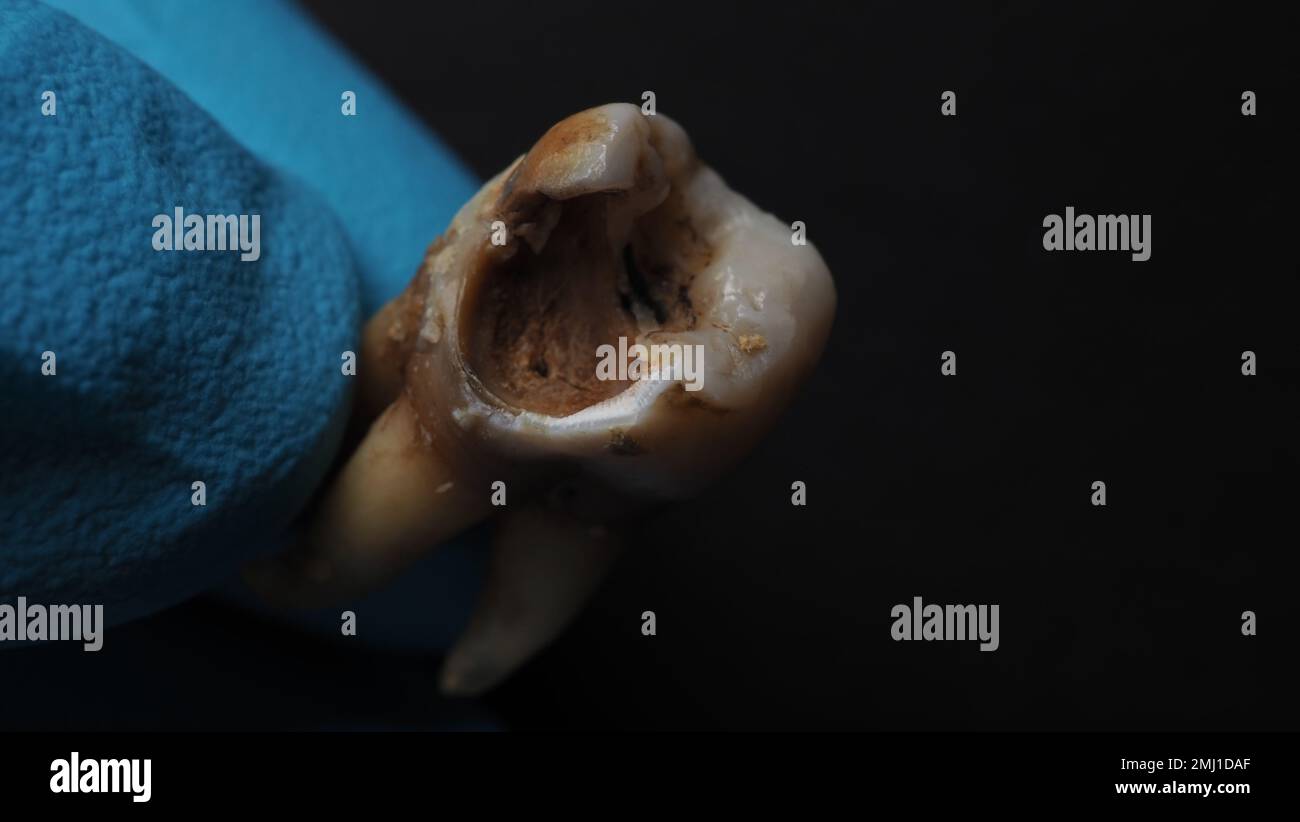Tooth decay and dentist hand with glove and black background. Macro ...