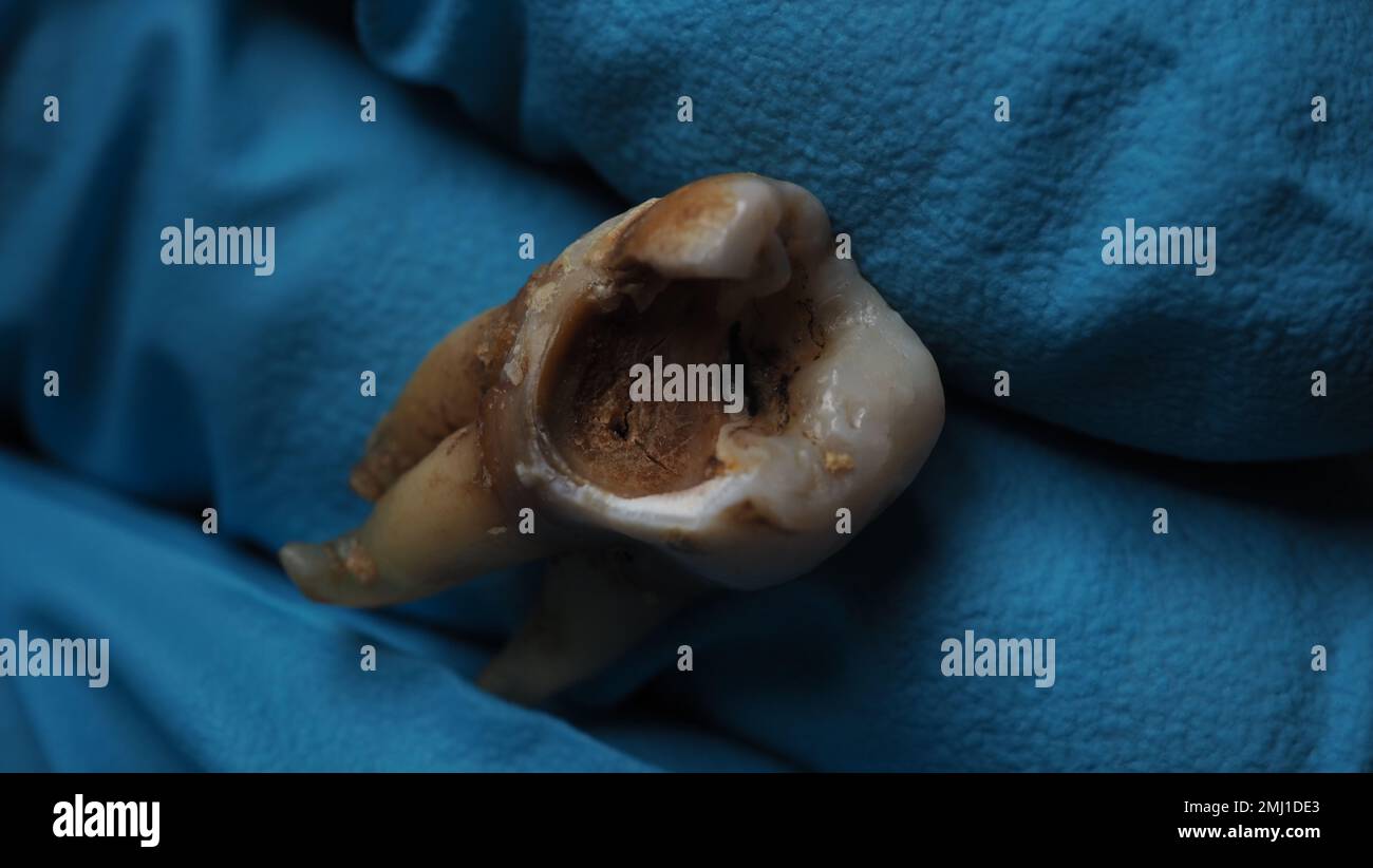 Tooth decay and dentist hand with glove and black background. Macro ...
