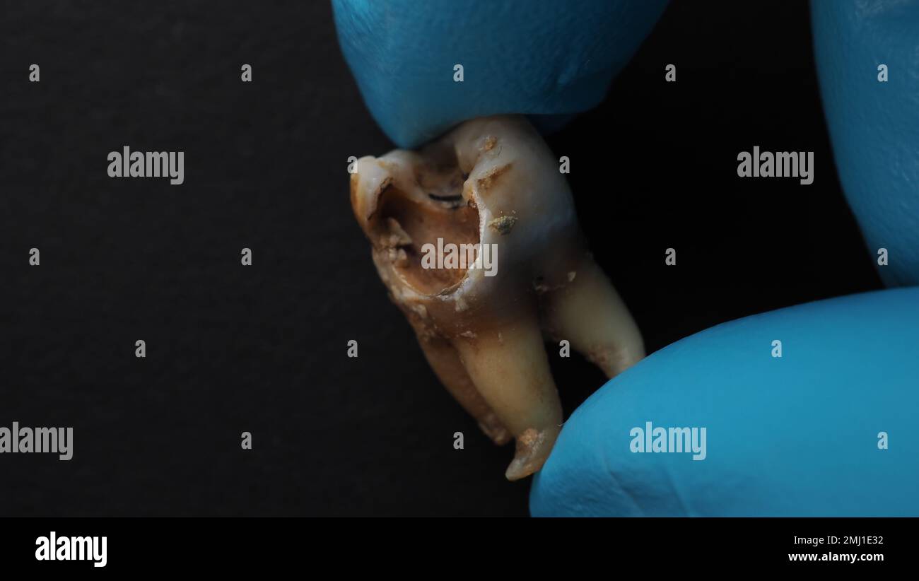 Tooth decay and dentist hand with glove and black background. Macro ...