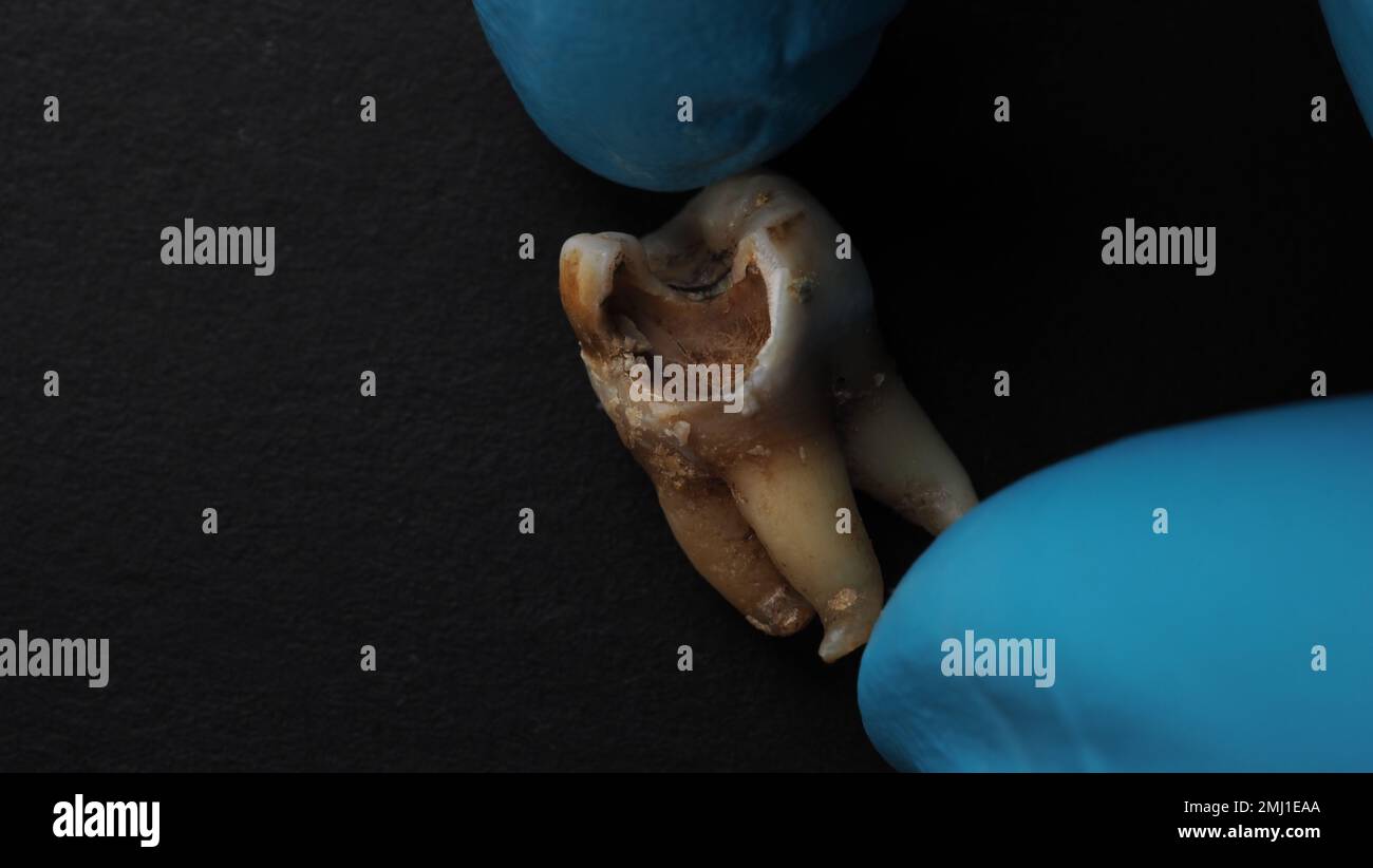Tooth decay and dentist hand with glove and black background. Macro ...