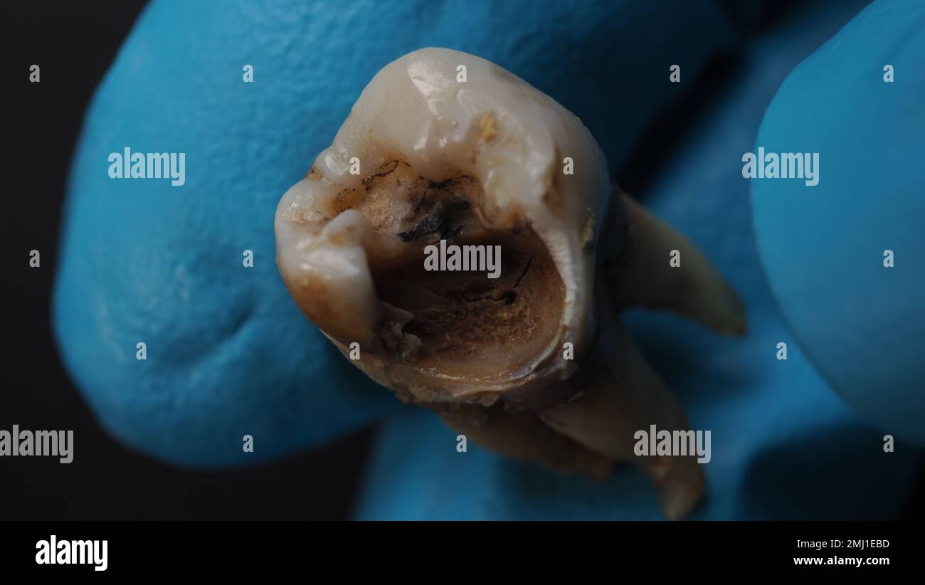 Tooth decay and dentist hand with glove and black background. Macro shot of a decayed teeth till ...