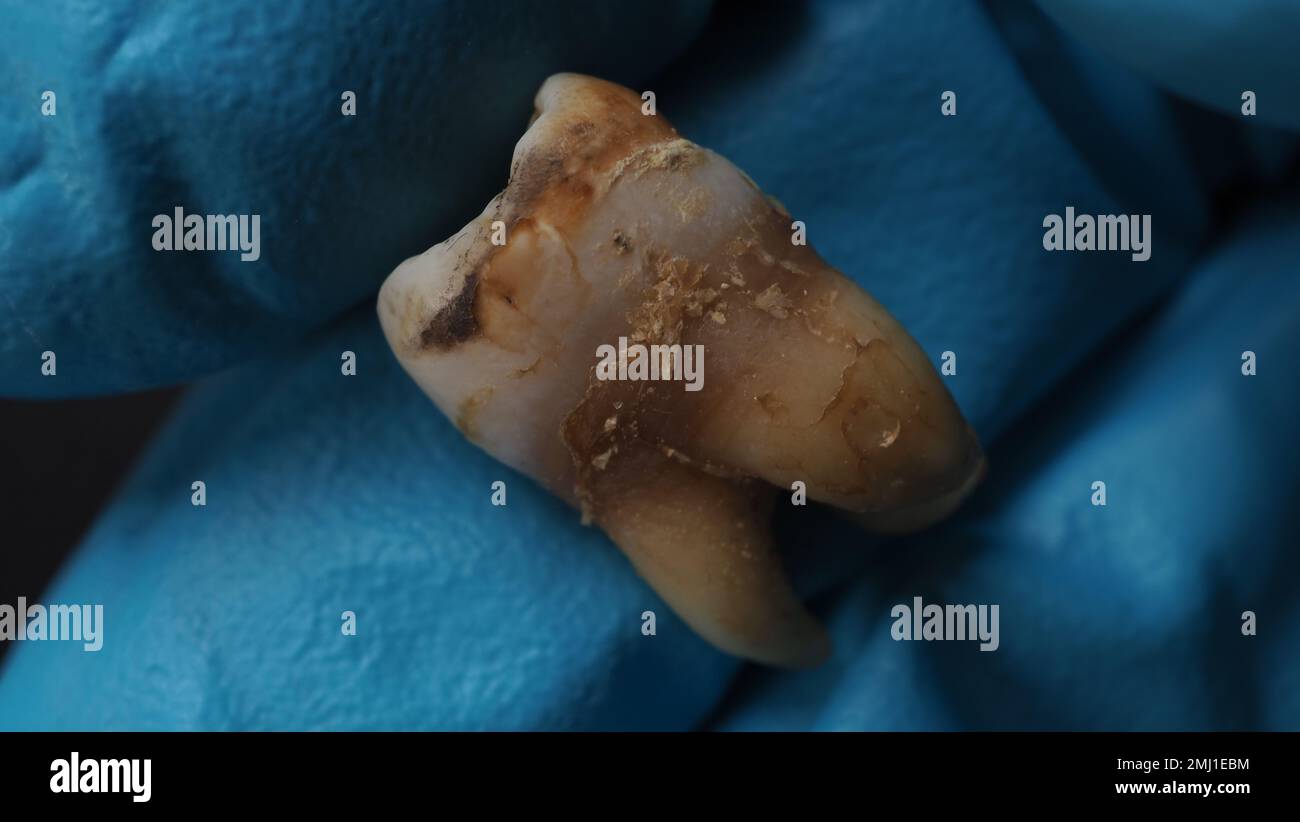 Tooth decay and dentist hand with glove and black background. Macro ...