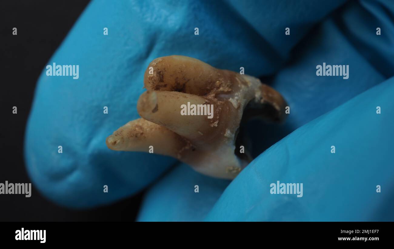 Tooth decay and dentist hand with glove and black background. Macro shot of a decayed teeth till ...