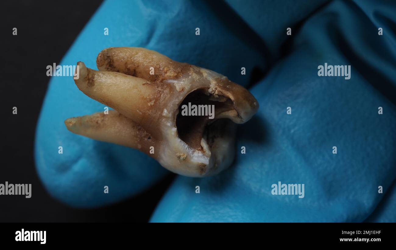 Tooth decay and dentist hand with glove and black background. Macro ...