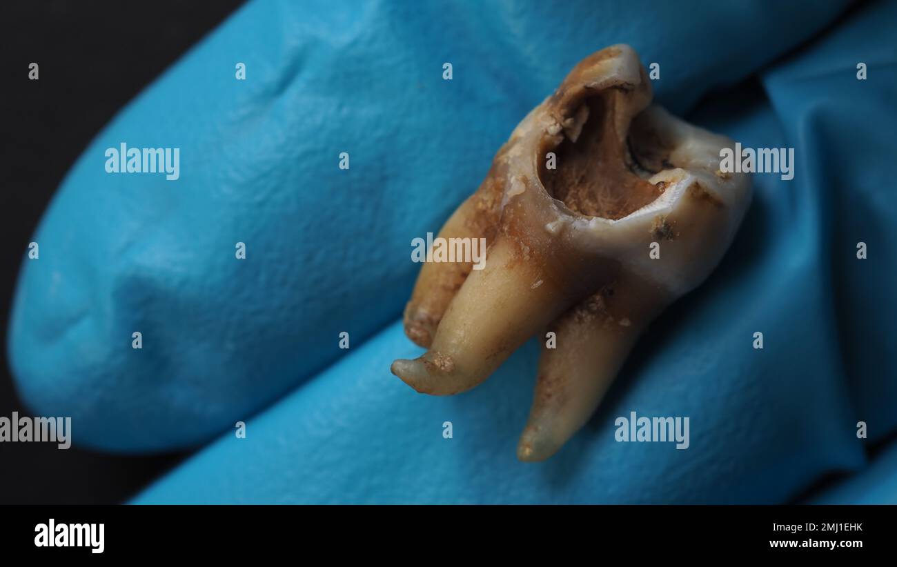 Tooth decay and dentist hand with glove and black background. Macro ...
