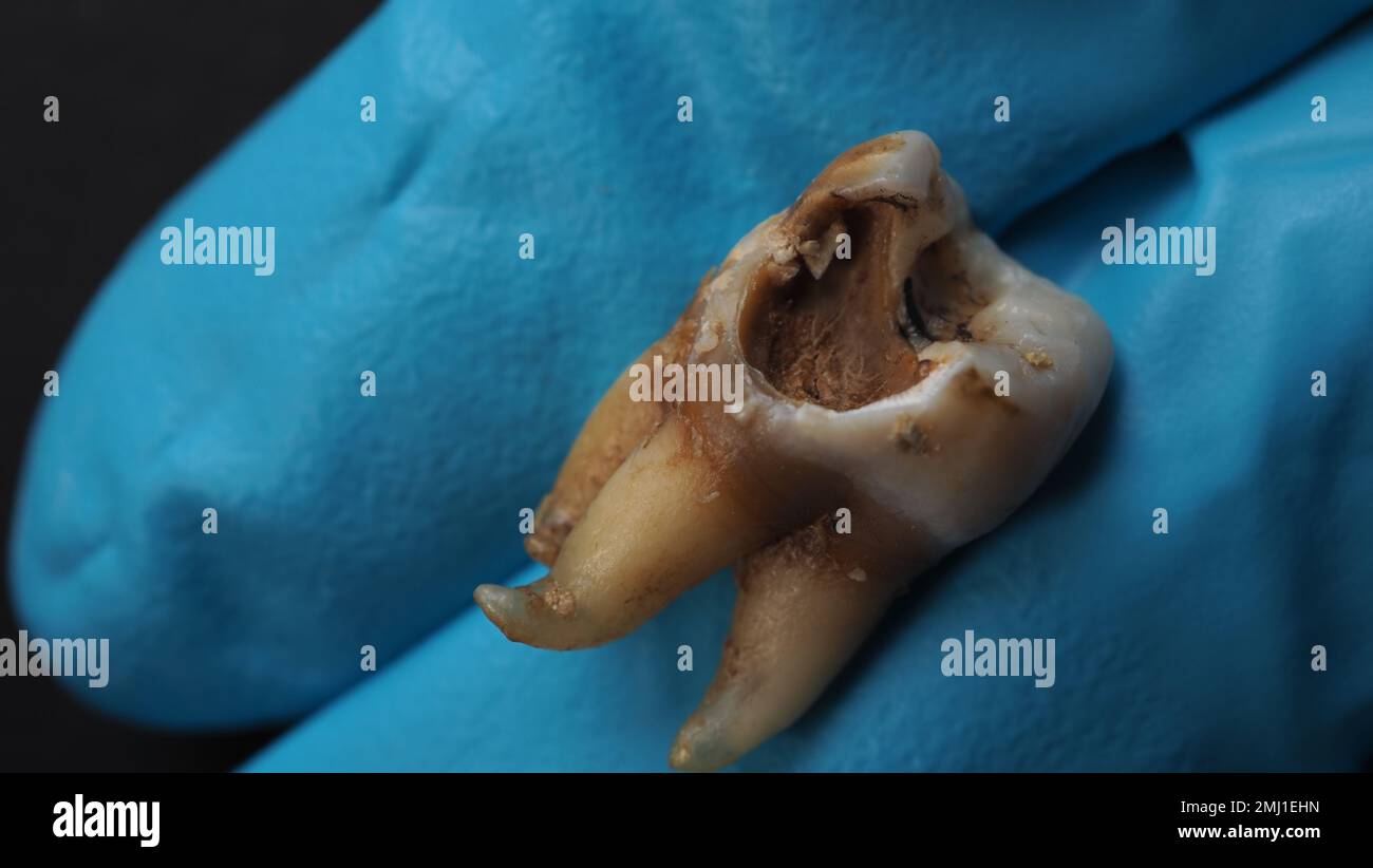 Tooth decay and dentist hand with glove and black background. Macro ...